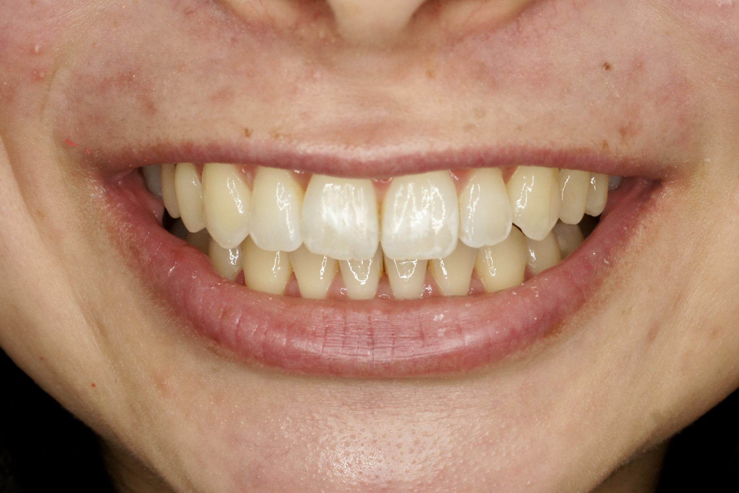 Invisalign - Castle View Dental Practice